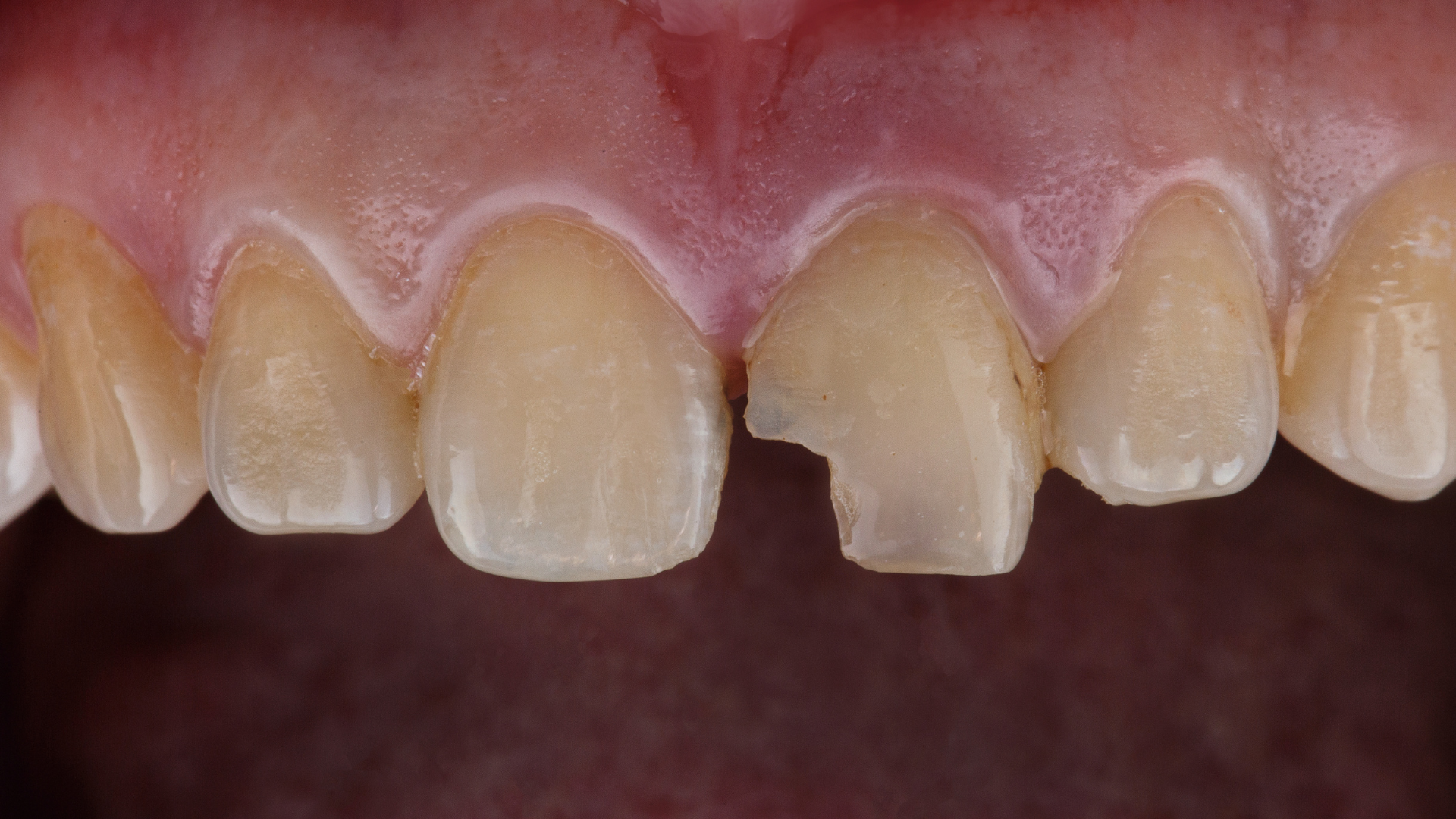 What to Do If You Chip a Tooth on Spring Break - Hart Family Dentistry